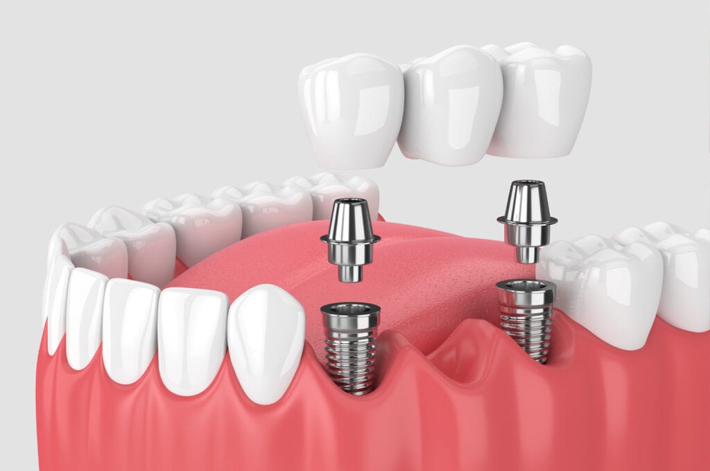 Dental Bridges | Central Hutt Dental | Lower Hutt Tooth Replacement